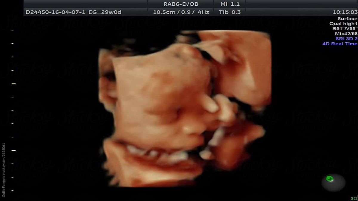 "Real Ultrasound Scan Of Baby In 4D" by Stocksy Contributor "Guille ...