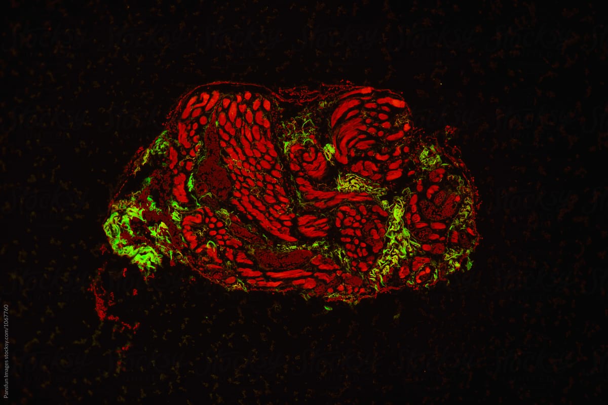 "Fluorescence Basal Cell Carcinoma Of Human" by Stocksy Contributor ...